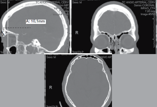 Tomographic Morphological Study of the Cranium and its Correlation with ...